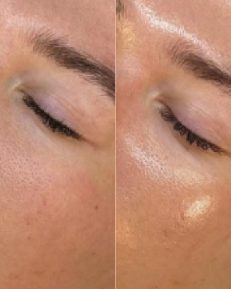 One (1) Signature HydraFacial - Full Face & Neck – TMS Online Store